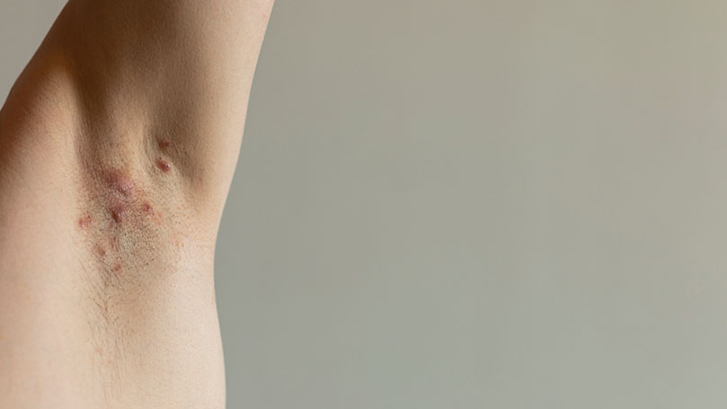 Was ist eigentlich Acne inversa? - PTAheute