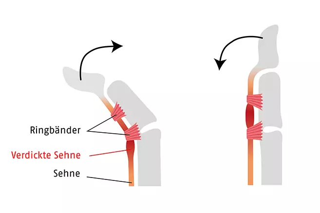 Was ist eigentlich ein Schnappfinger? - PTAheute